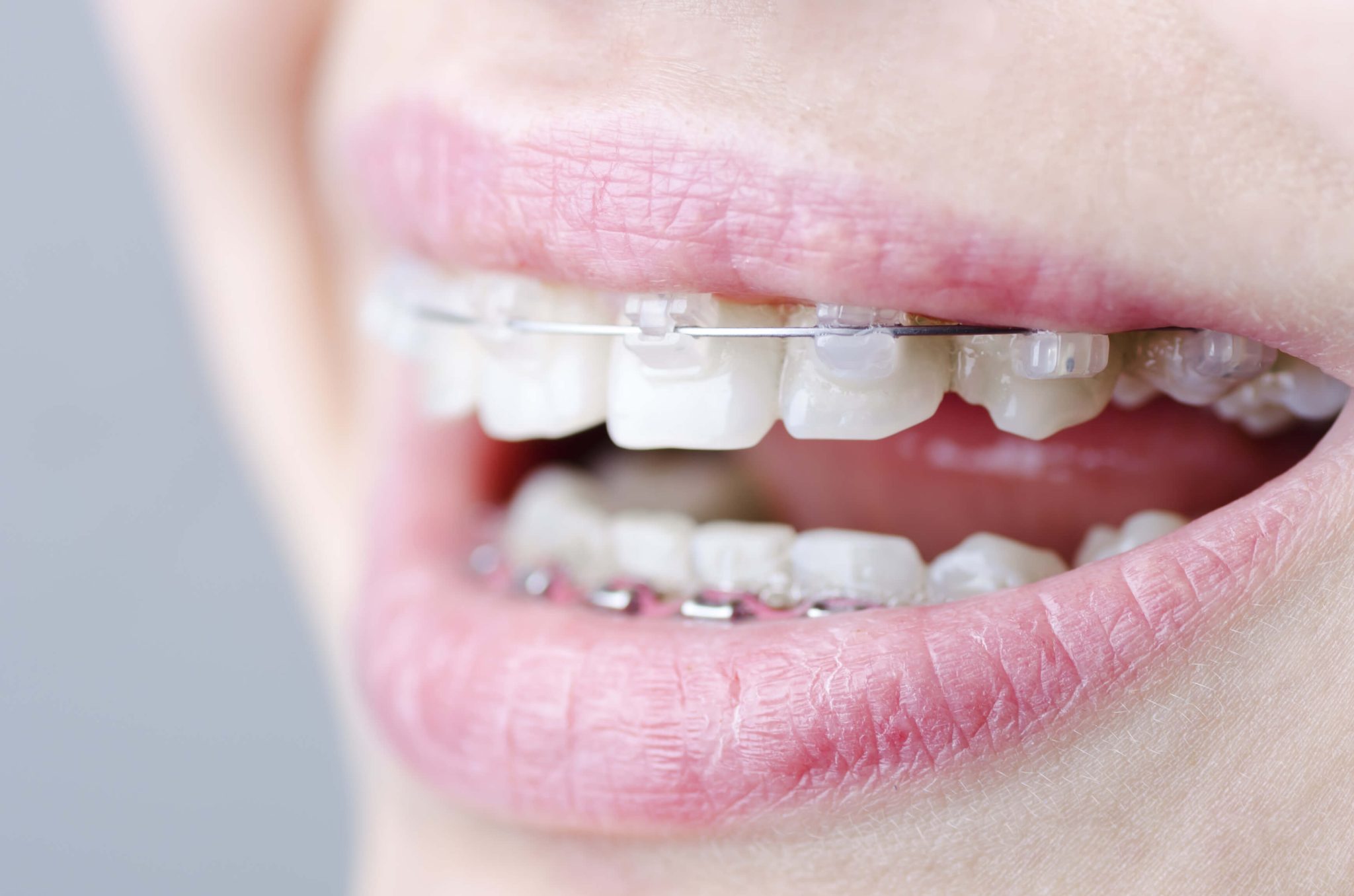 Aparat dentar ceramic. Ce este si care sunt avantajele acestuia